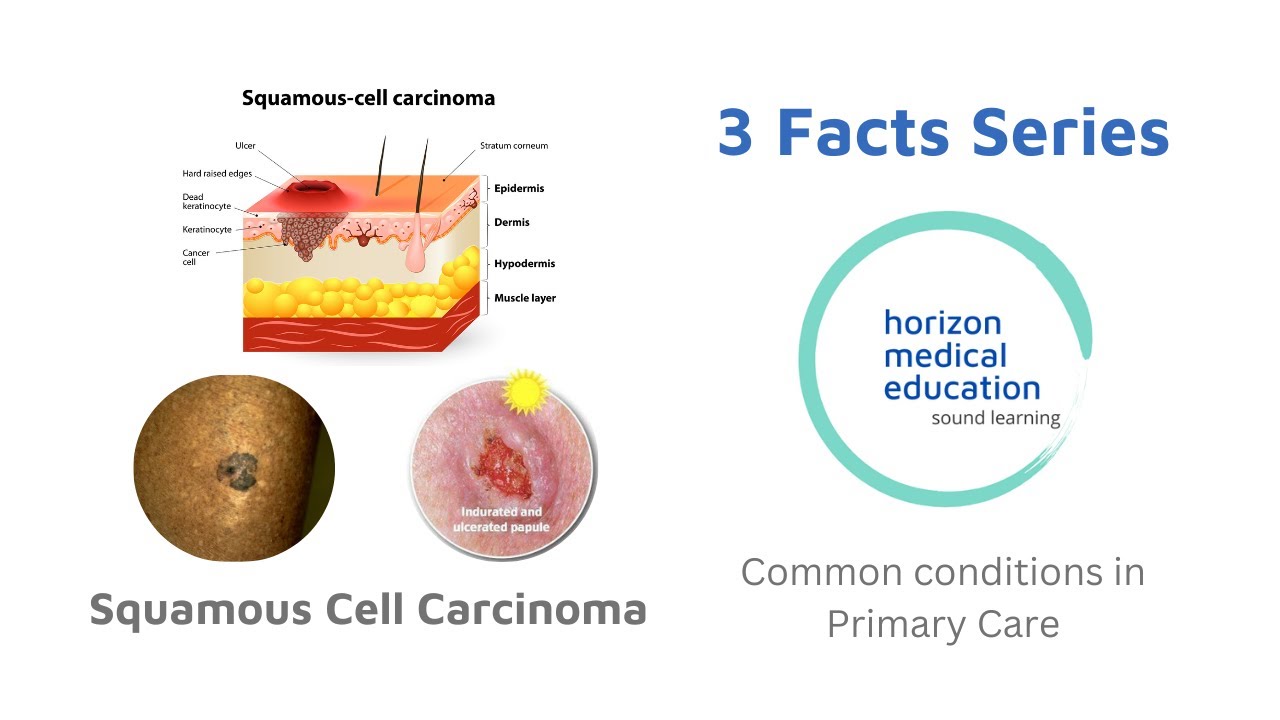 Squamous cell carcinoma #3facts #SCC #Skincancer - YouTube