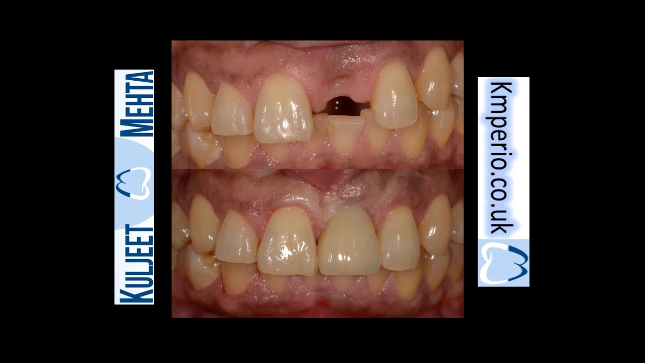 Dental implant with Grafting & Cement retained crown. - YouTube