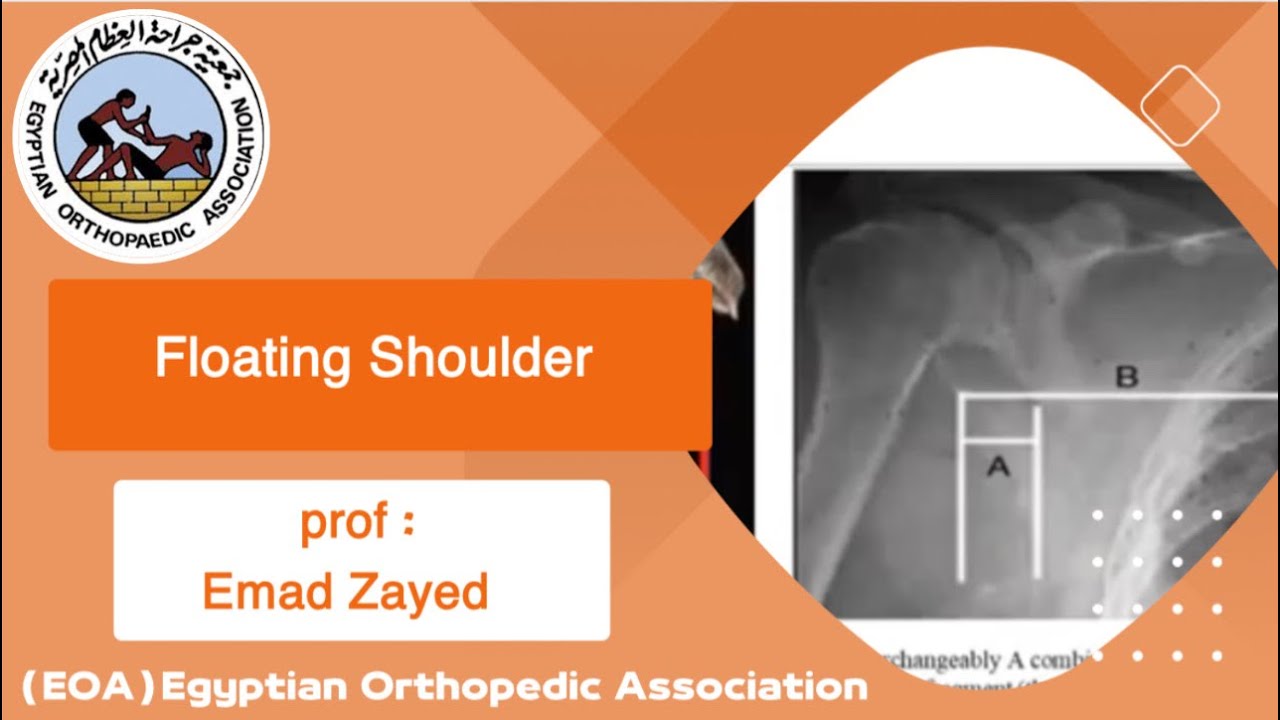 Floating Shoulder (prof Emad Zayed ) - YouTube