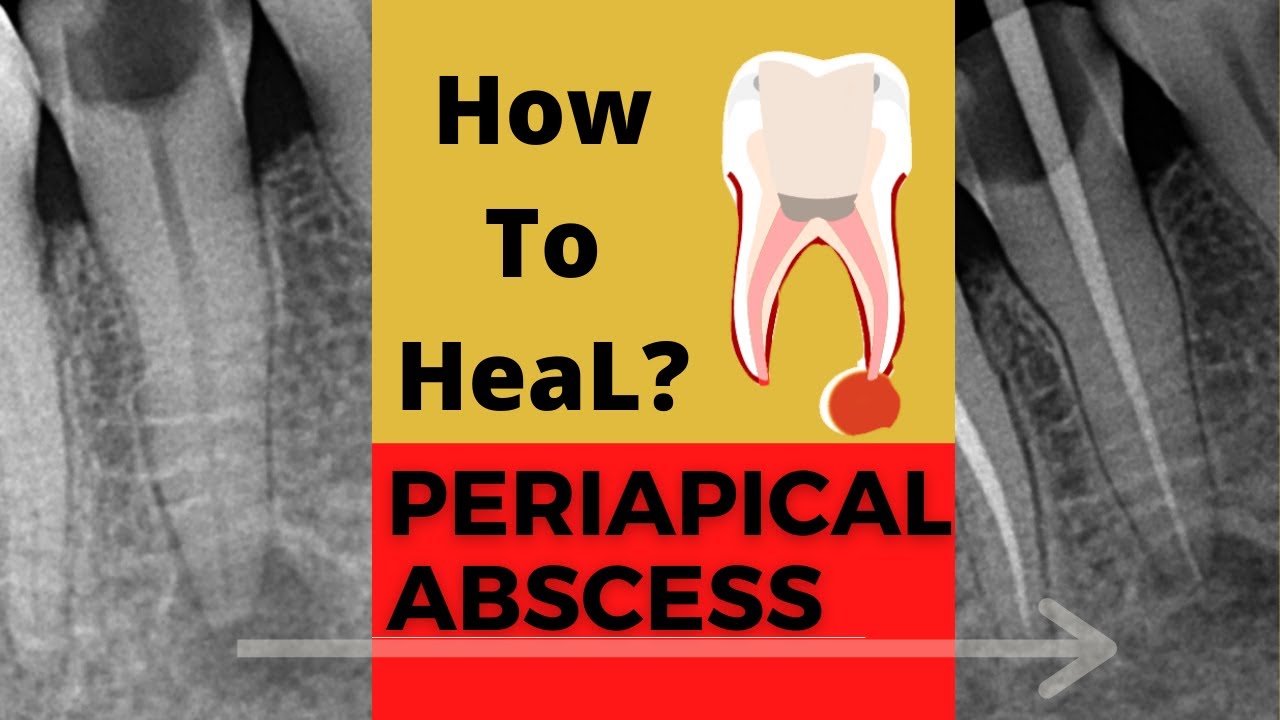 Case of PERIAPICAL ABSCESS| Dr. Sunil kumar| Dental ji - YouTube