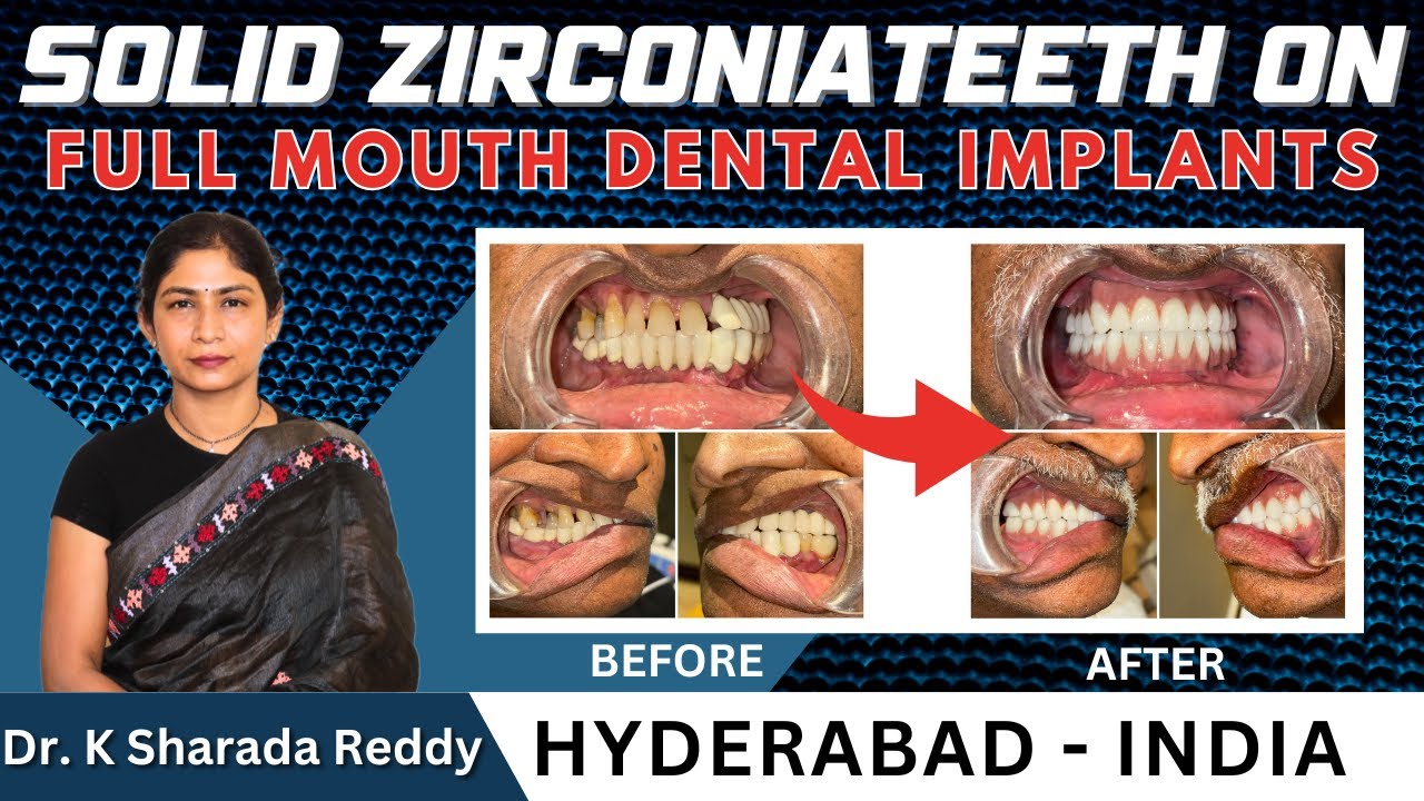 Types of Fixed Teeth on Full Mouth Dental Implants | Why Zirconia on ...