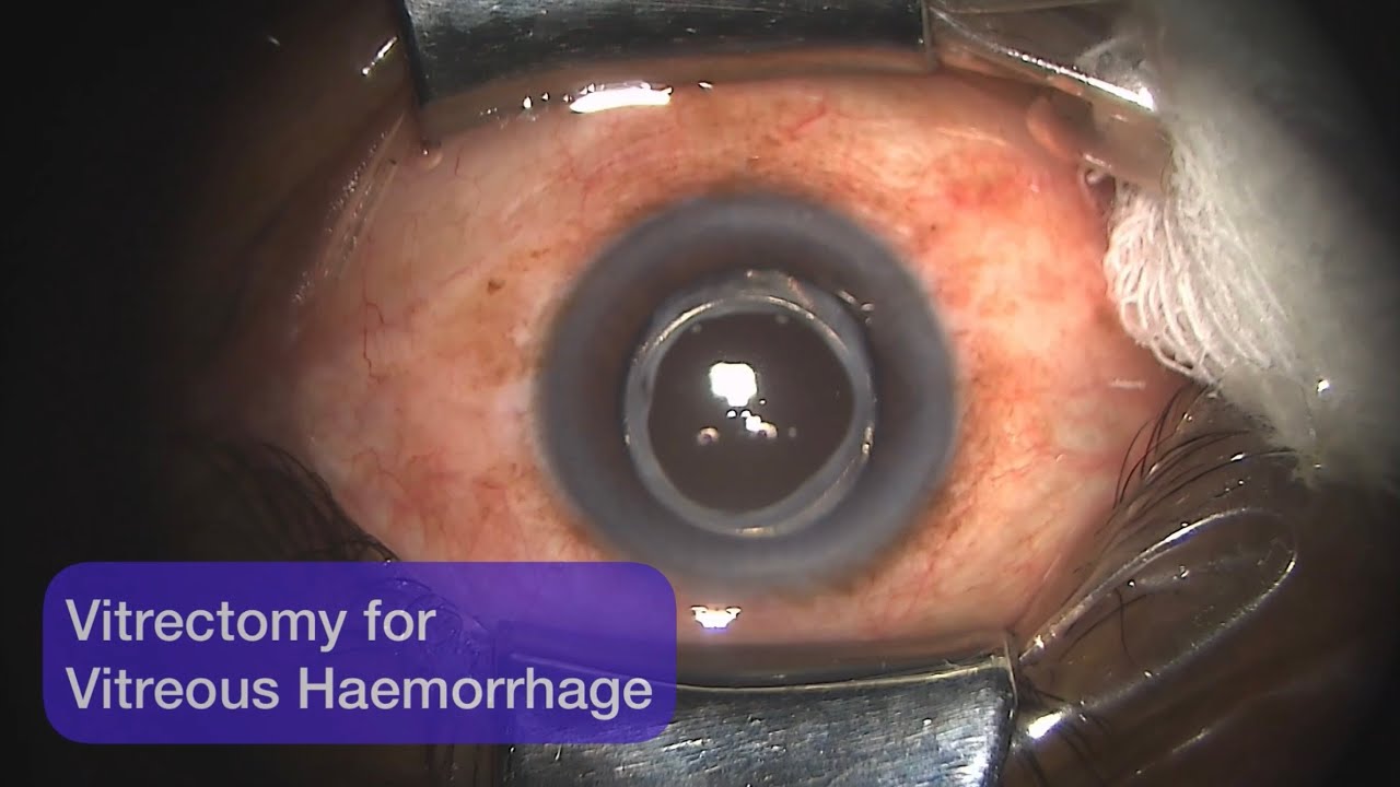 Vitrectomy for Vitreous Haemorrhage in Diabetic Retinopathy - YouTube