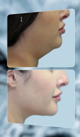 Get Rid of a Double Chin with CoolSculpting! - Double Chin Before and ...