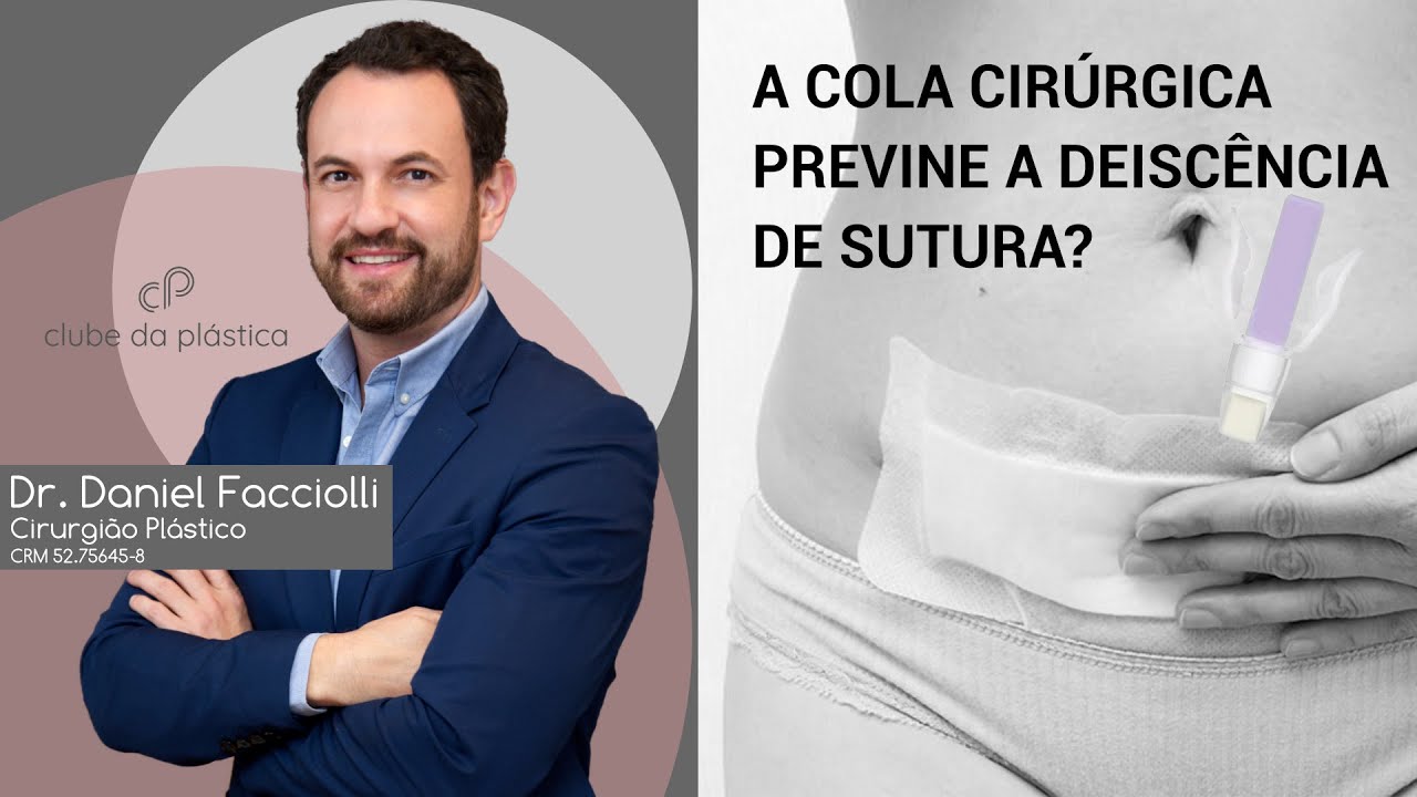 Clube da Plástica: a cola cirúrgica previne a deiscência de sutura ...