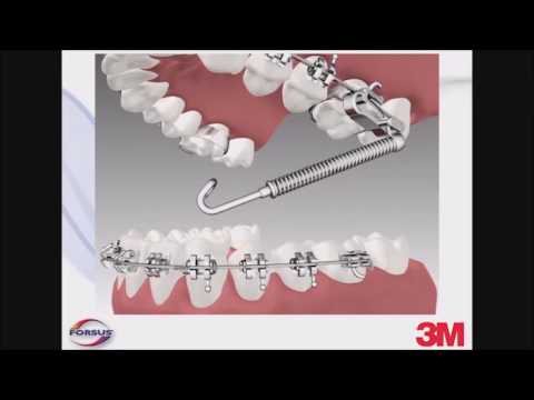 12 FORSUS EZ - YouTube