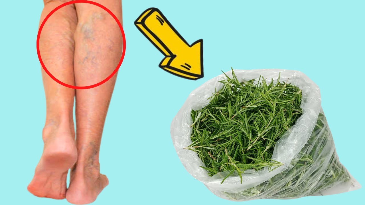Venas Inflamadas en las Piernas, ¿Cómo ELIMINARLAS? 🔥 Deshazte de las ...