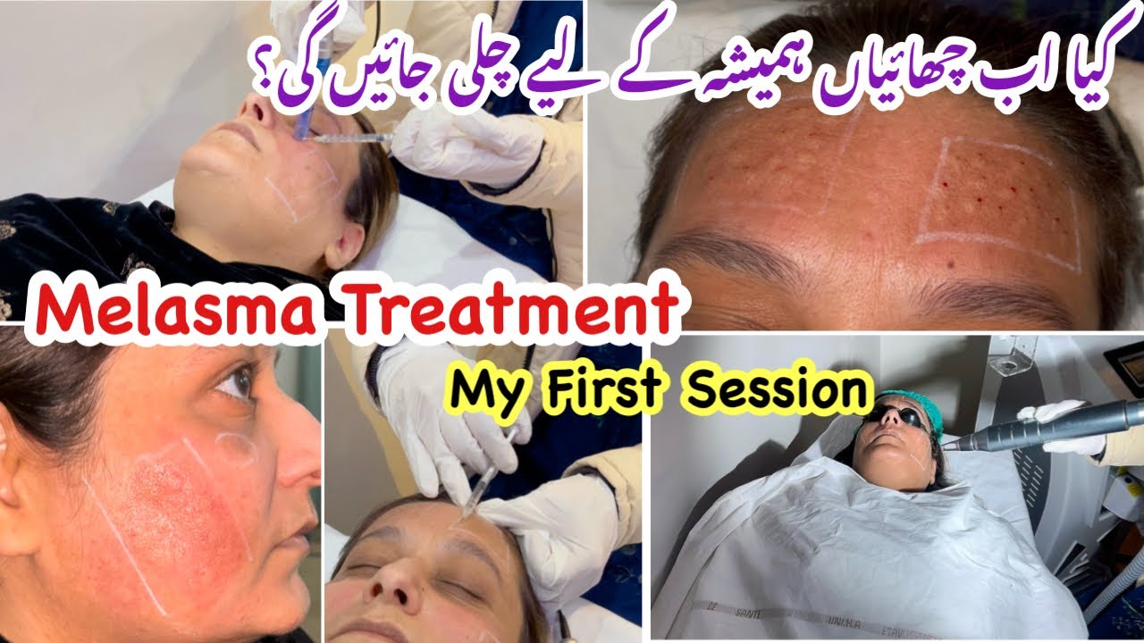 How to treat Melasma|My honest reviews about Mesotherapy|Skin ...