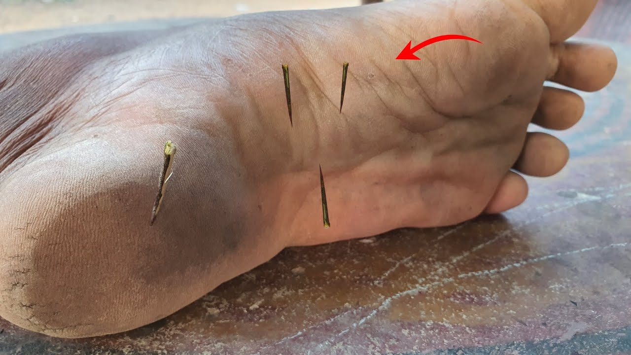 How to remove splinter from shoes - YouTube