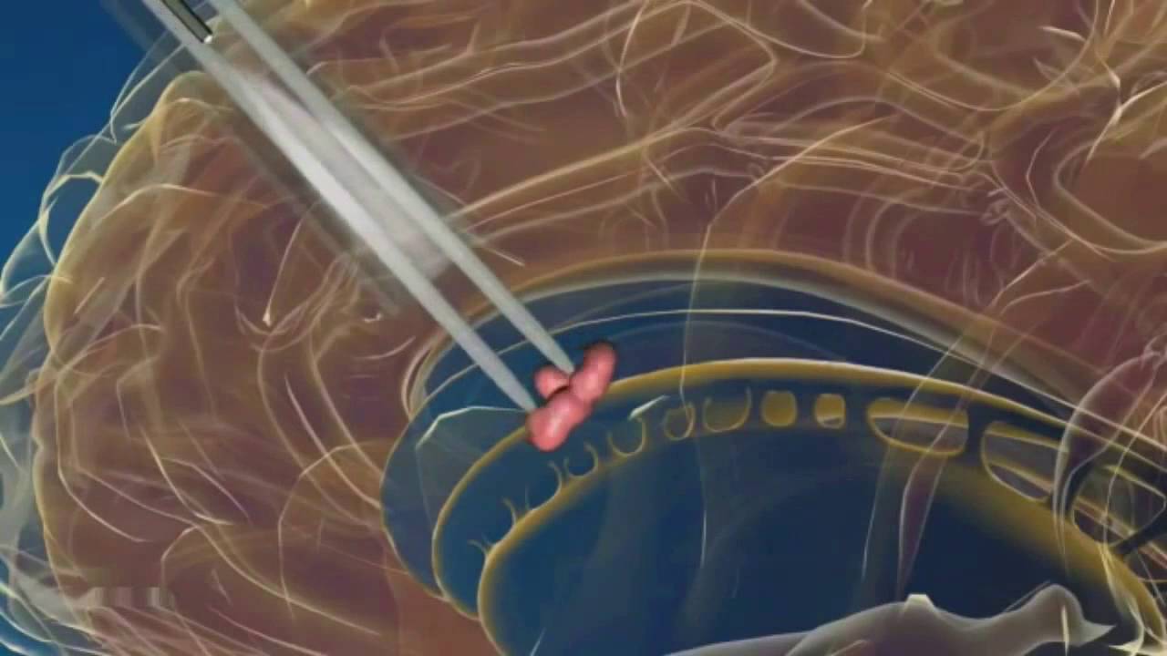 Brain Tumor Extraction with StealthStation Navigation System - YouTube