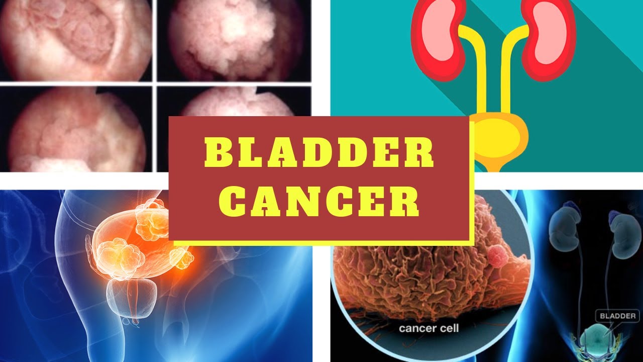 What is Bladder Cancer - How Bladder cancer Occurs? Causes Stages ...