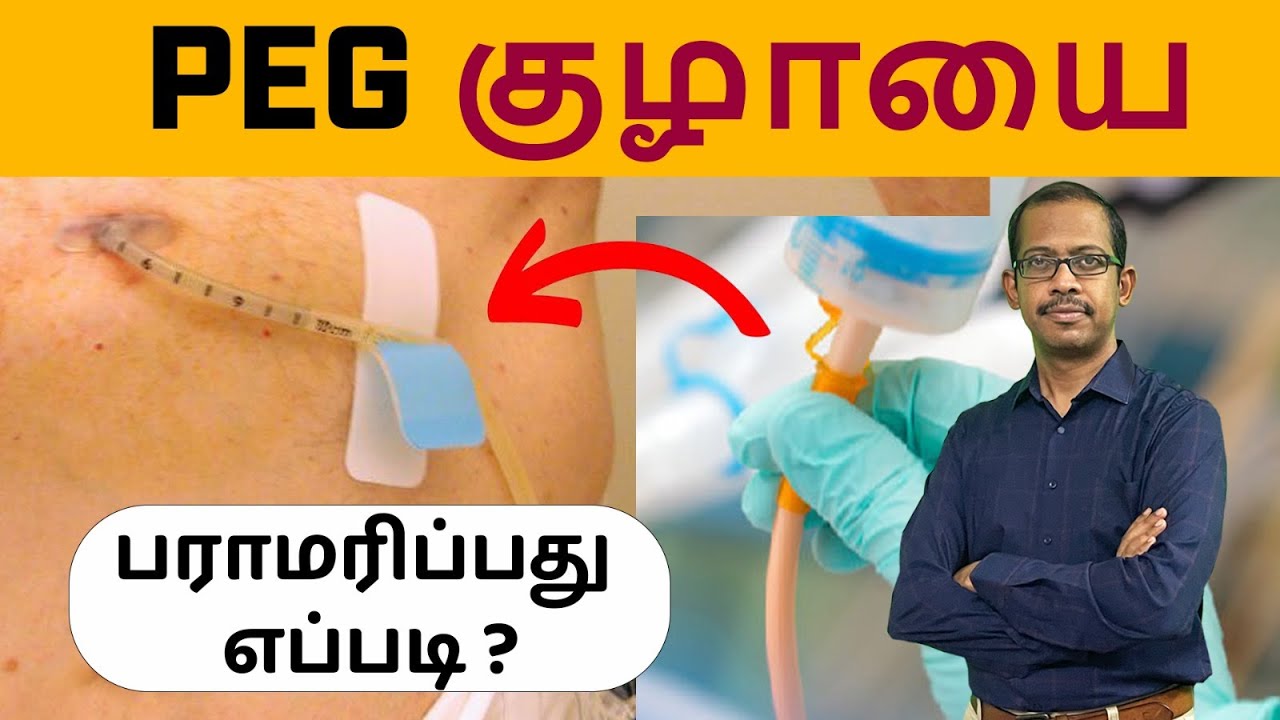 🧠PEG (Percutaneous Endoscopic Gastrostomy) Care ? | PEG குழாயை ...