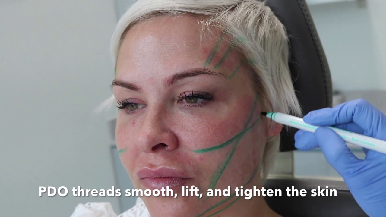 NONSURGICAL FACE LIFT! - with PDO Threads - YouTube