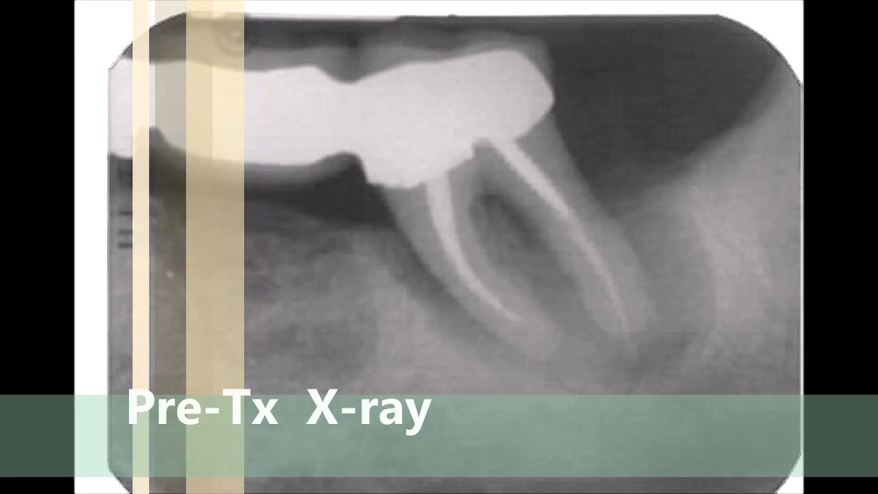 Fantastic Perioscopy / LANAP results of a "hopeless" tooth - YouTube
