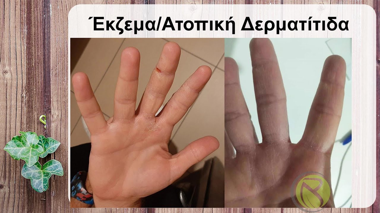 Βρέθηκε η Θεραπεία για το Έκζεμα ή αλλιώς την Ατοπική Δερματίτιδα ...