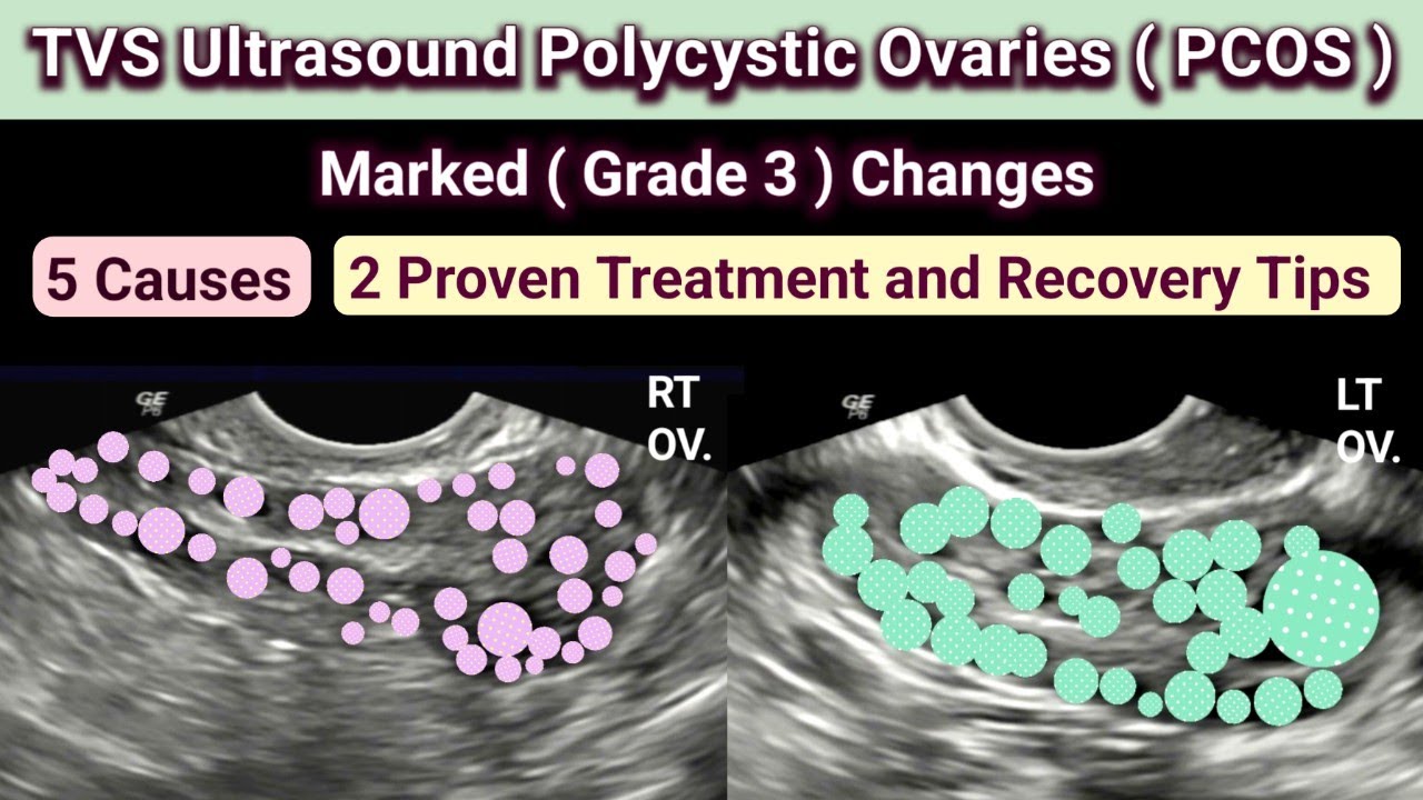 Polycystic Ovary Syndrome ( PCOS )- TVS Ultrasound | Causes | Treatment ...