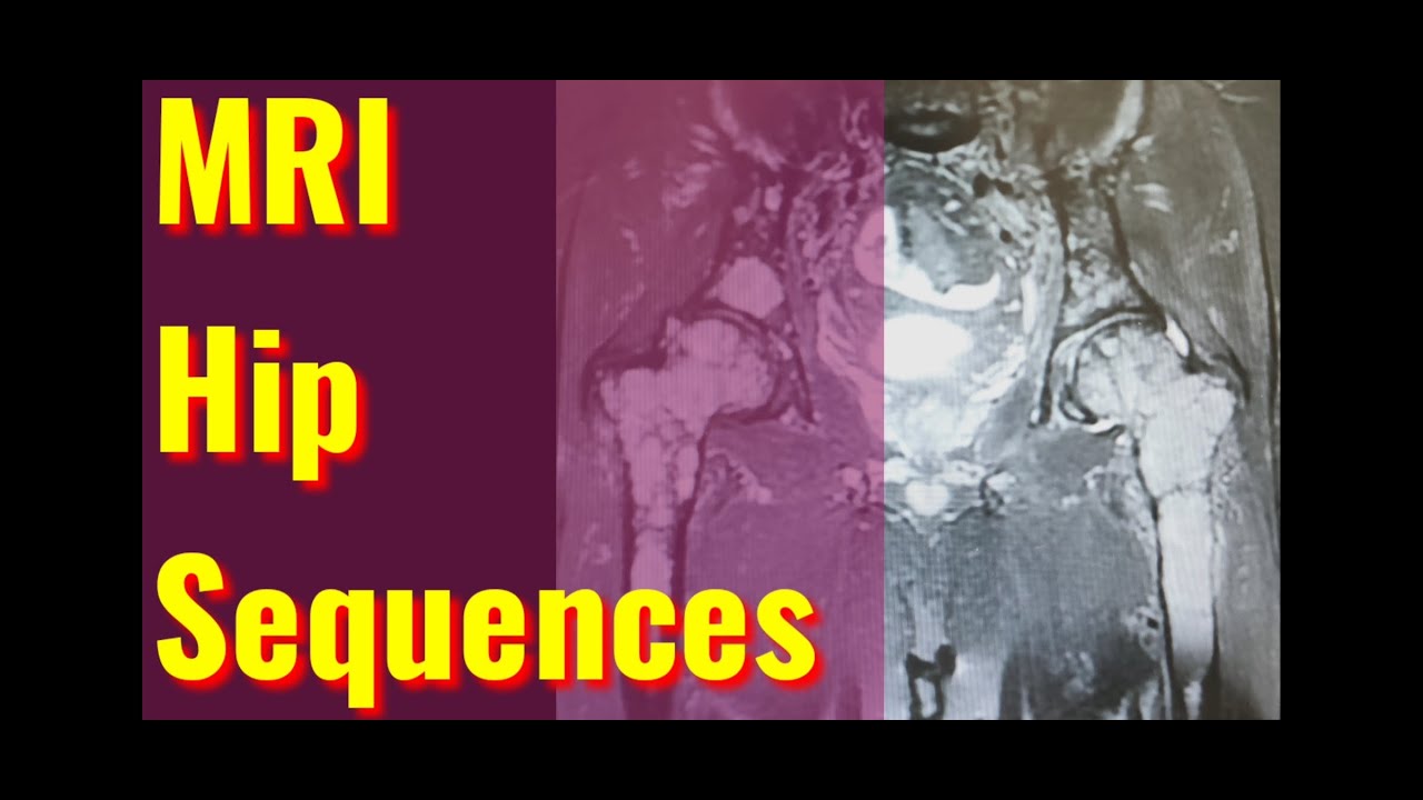 MRI Hip Sequences for Myelopathy - YouTube
