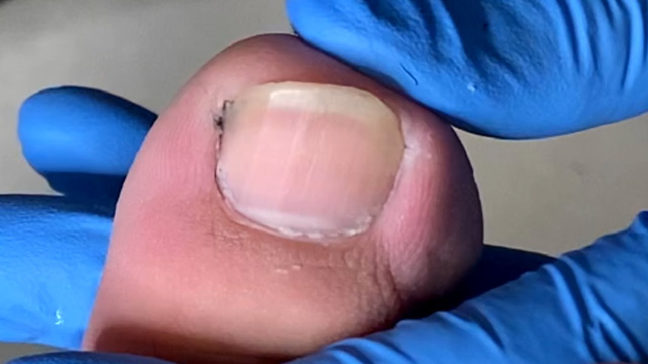 Pedicure tutorial ：Painless treatment of paronychia【Xue Yidao】 - YouTube