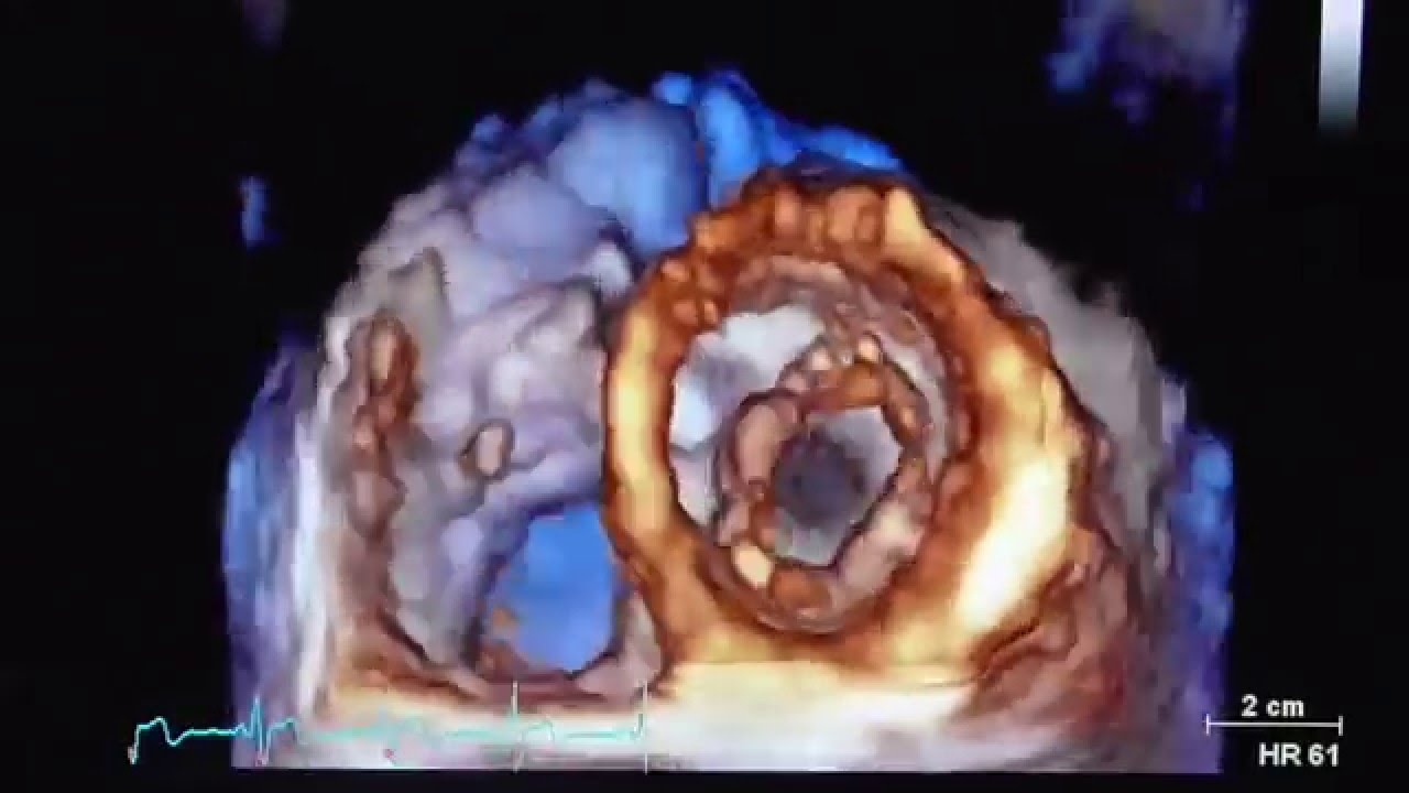 3d 4d Echokardiographie 3d 4d Echocardiography Youtube