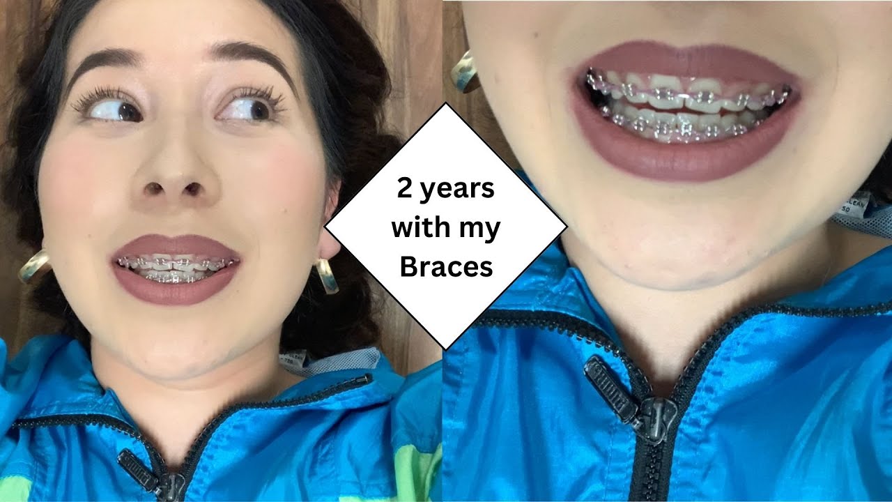 2 Years Braces Update | Braces Journey: Power Chains, Elastics, Over ...