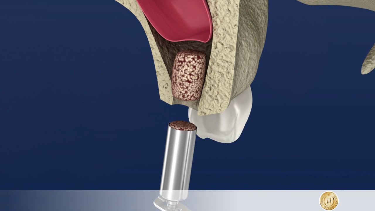 Implantologie: Knochenaufbau mit Sinuslift für stabile Zahnimplantate ...