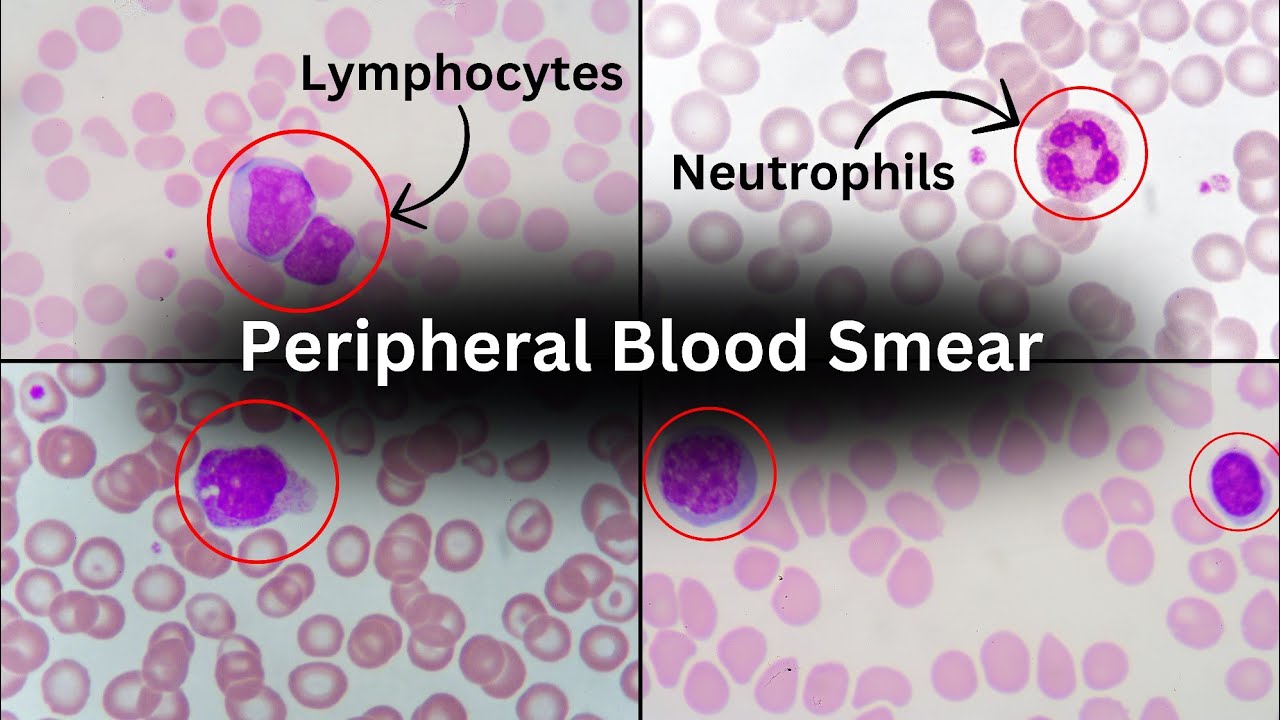 Peripheral smear for Malaria parasite | PS MP | Blood smear | Thick and ...