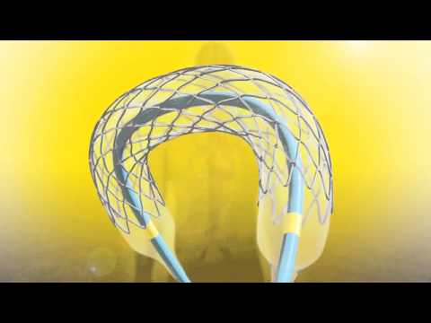 Resolute Integrity Coronary Stent System - YouTube