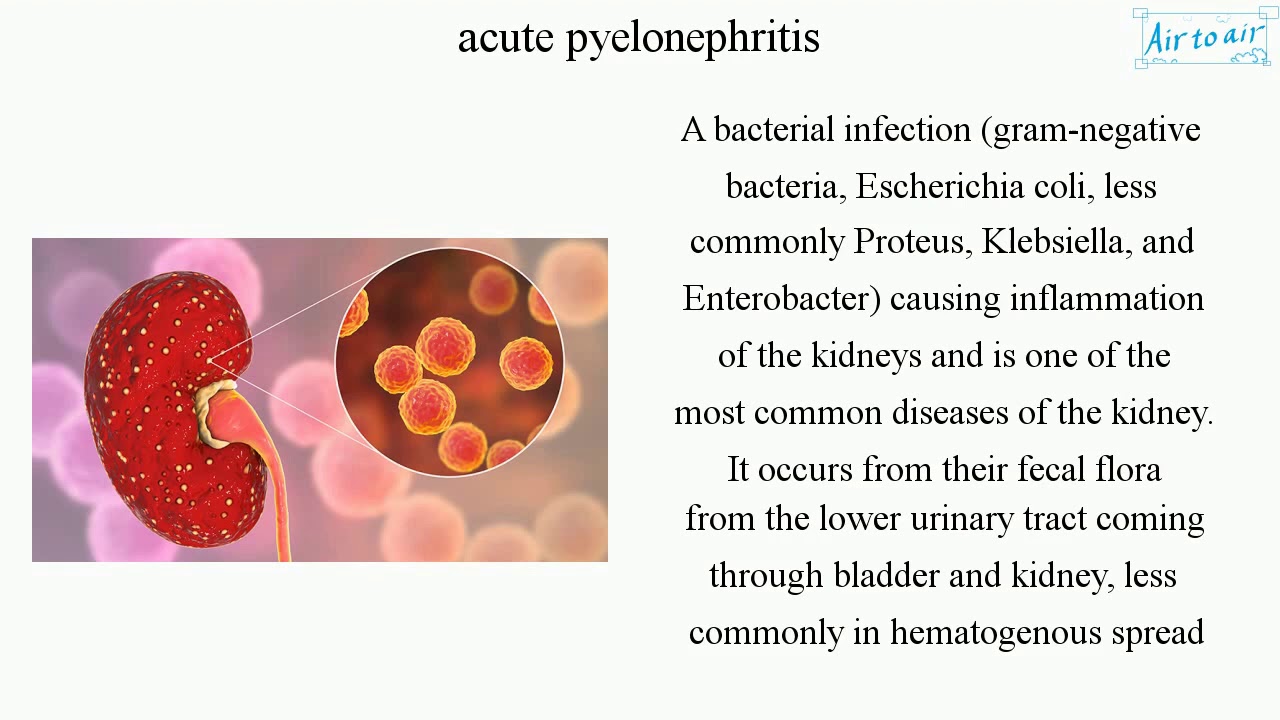 acute pyelonephritis - YouTube