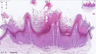 Verruca Plana Histopathology Verrucous Plaques On Sun Exposed Areas