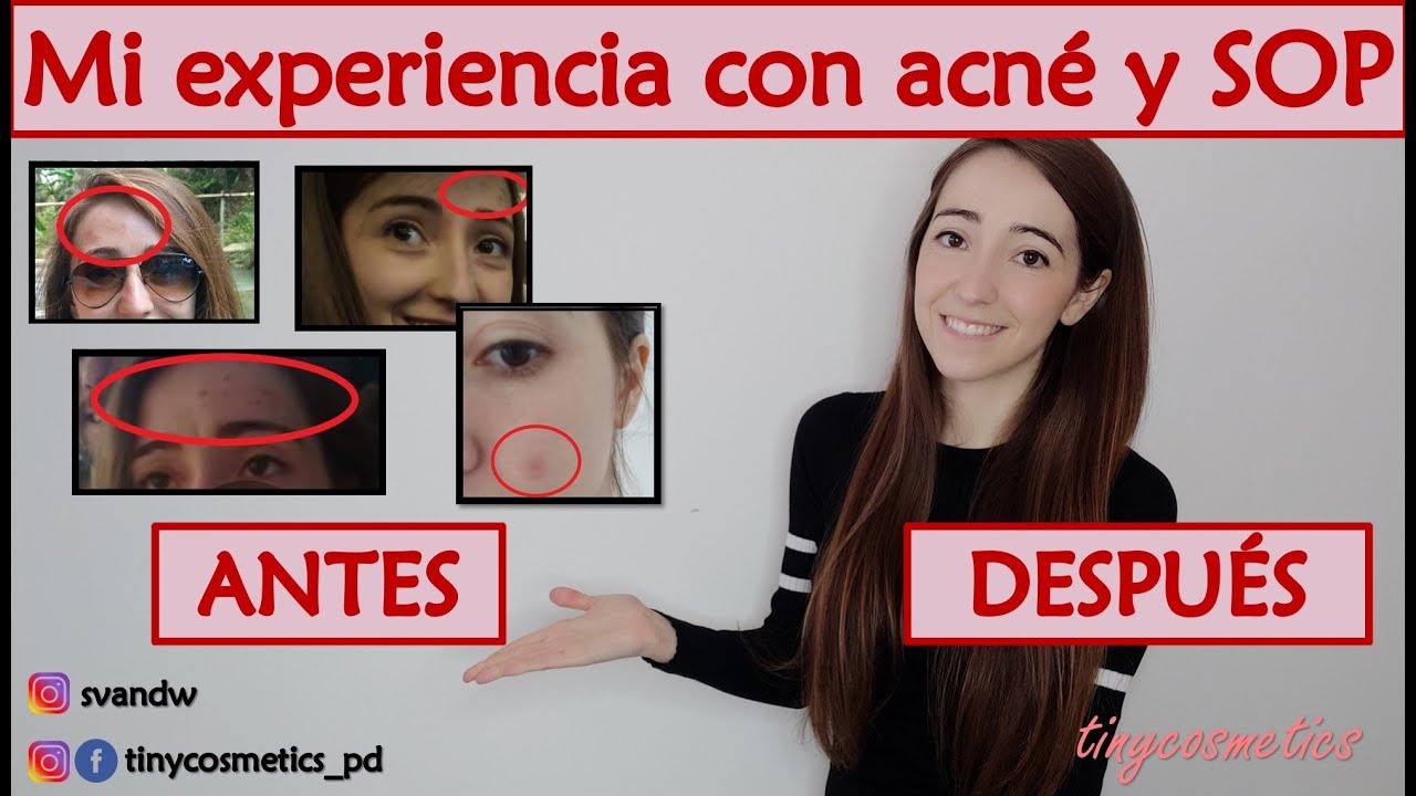 Mi experiencia con acné hormonal con SOP (Síndrome de Ovario ...