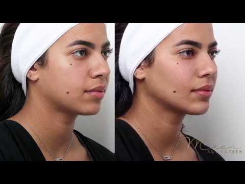 MAX-FAX Sculpting by Dr.Maen - YouTube