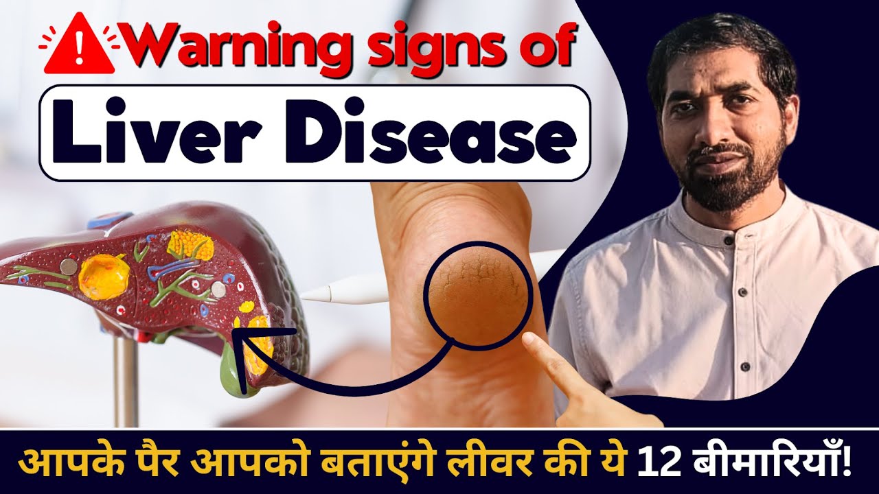 Signs Of Liver Disease | Your Feet Can Tell You About Your Liver - YouTube