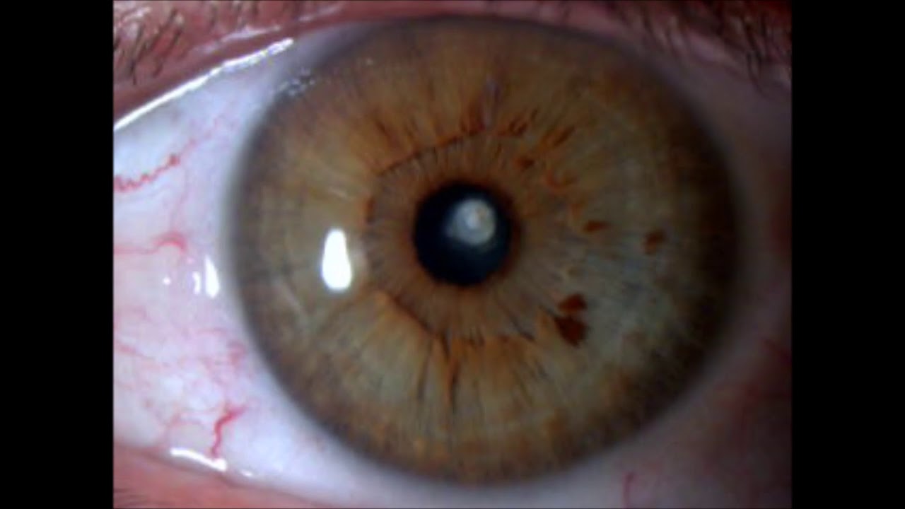 CATARATA OCULAR / CATARACT / OPACIDAD LENTICULAR / OPACIDAD DEL ...