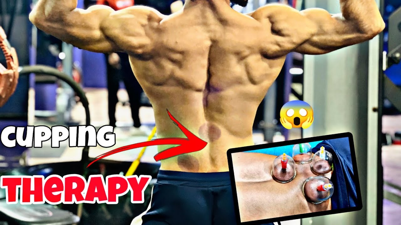 CUPPING THERAPY |Vlog-1| ||And Shoulder workout|| - YouTube