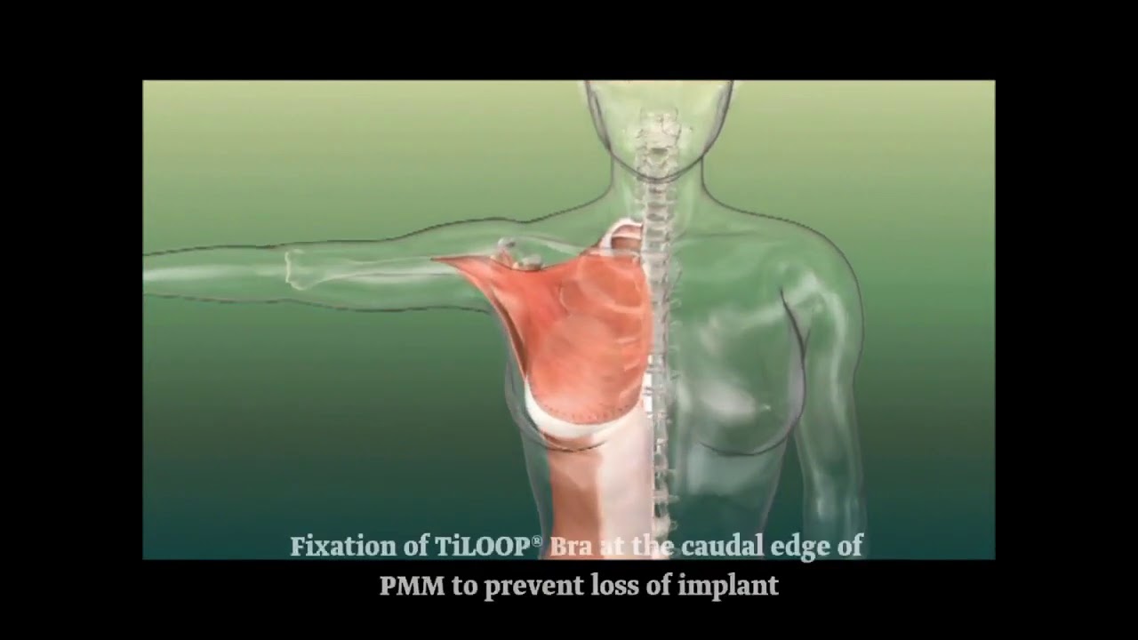PFM Medical Mesh Implant : TiLOOP Bra Animation One Stage ...