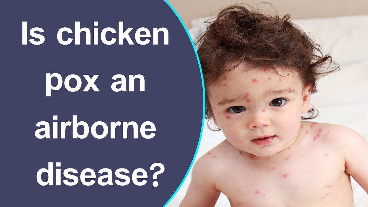Is chicken pox an airborne disease? - YouTube