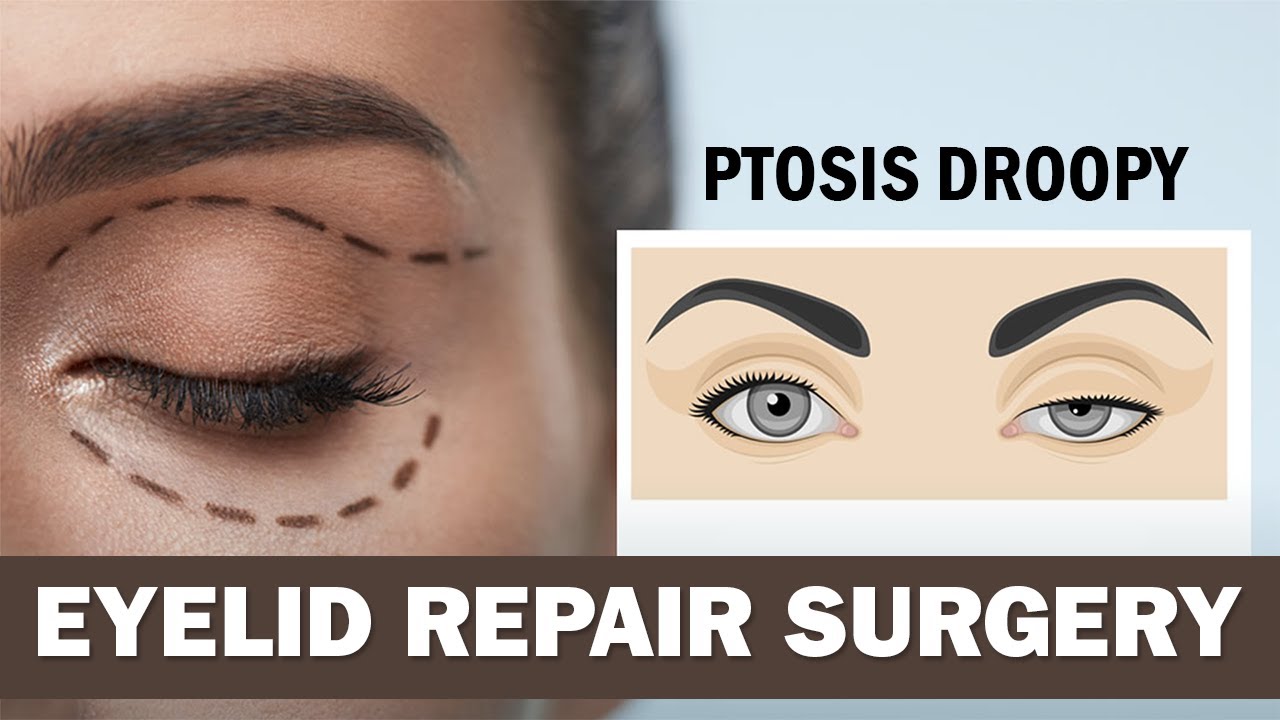 How to fix Droopy Eyelids? Repair Droopy Eyelids with Ptosis Surgery in ...