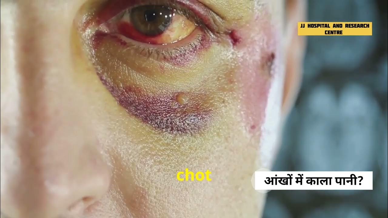 अगर आंखों में काला पानी हो जाए तो क्या करे Youtube