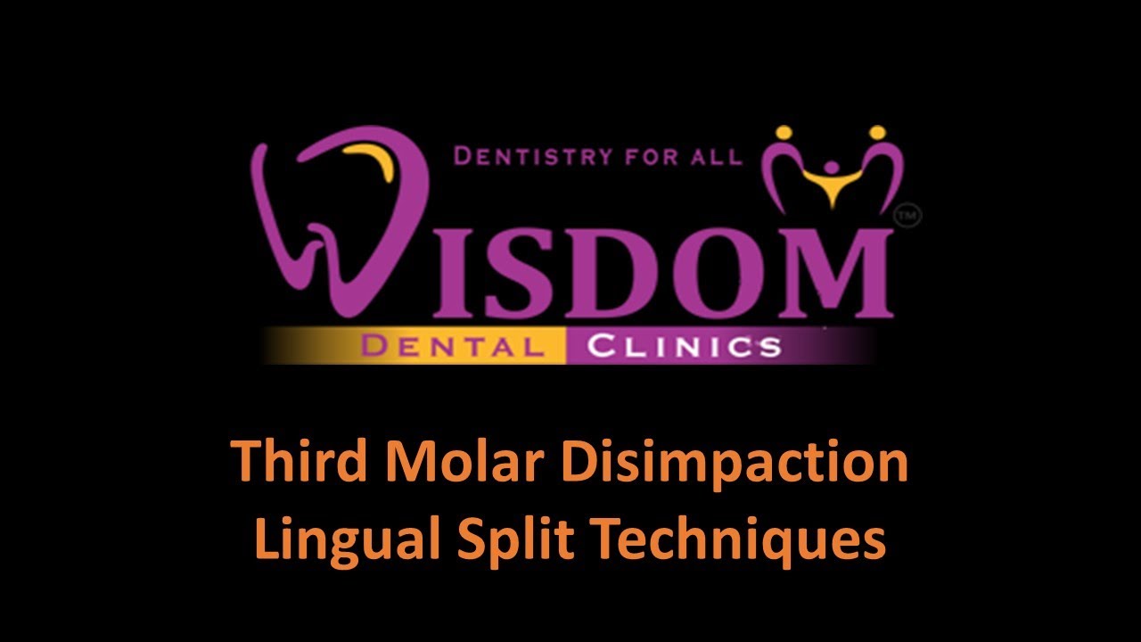 Third Molar Disimpaction Lingual Split Techniques - YouTube