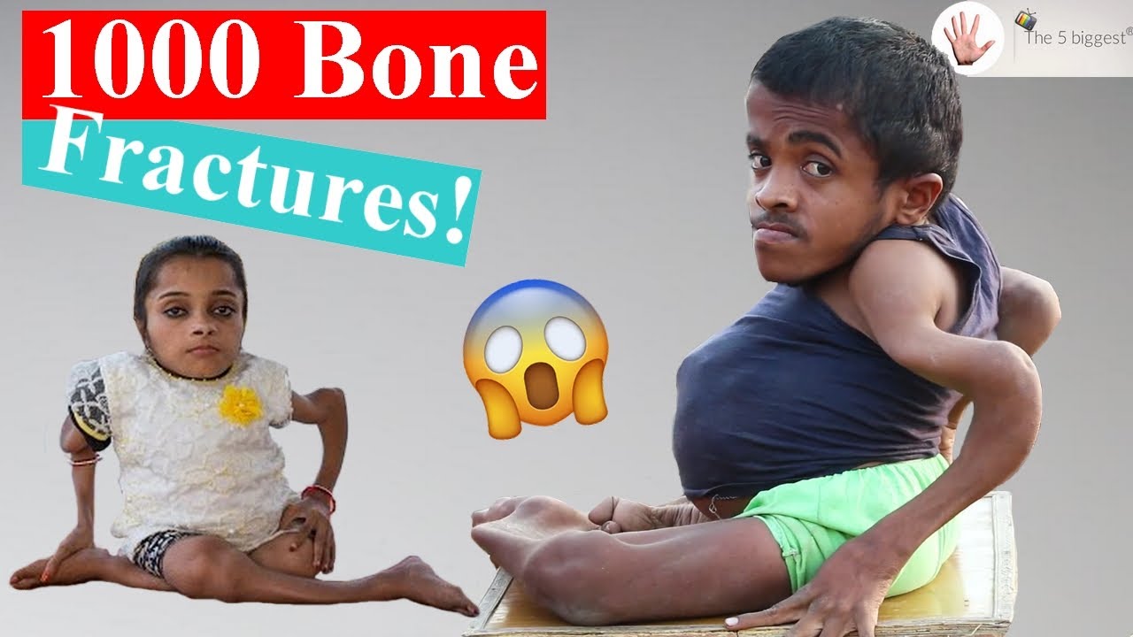 Medical Mystery is Making My Bones Bend! ~ Body Bizarre! - YouTube