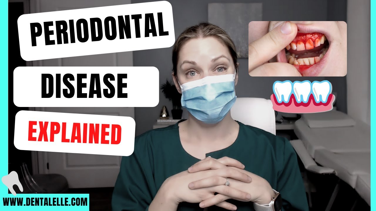 Periodontal Disease and the Pockets Explained - YouTube