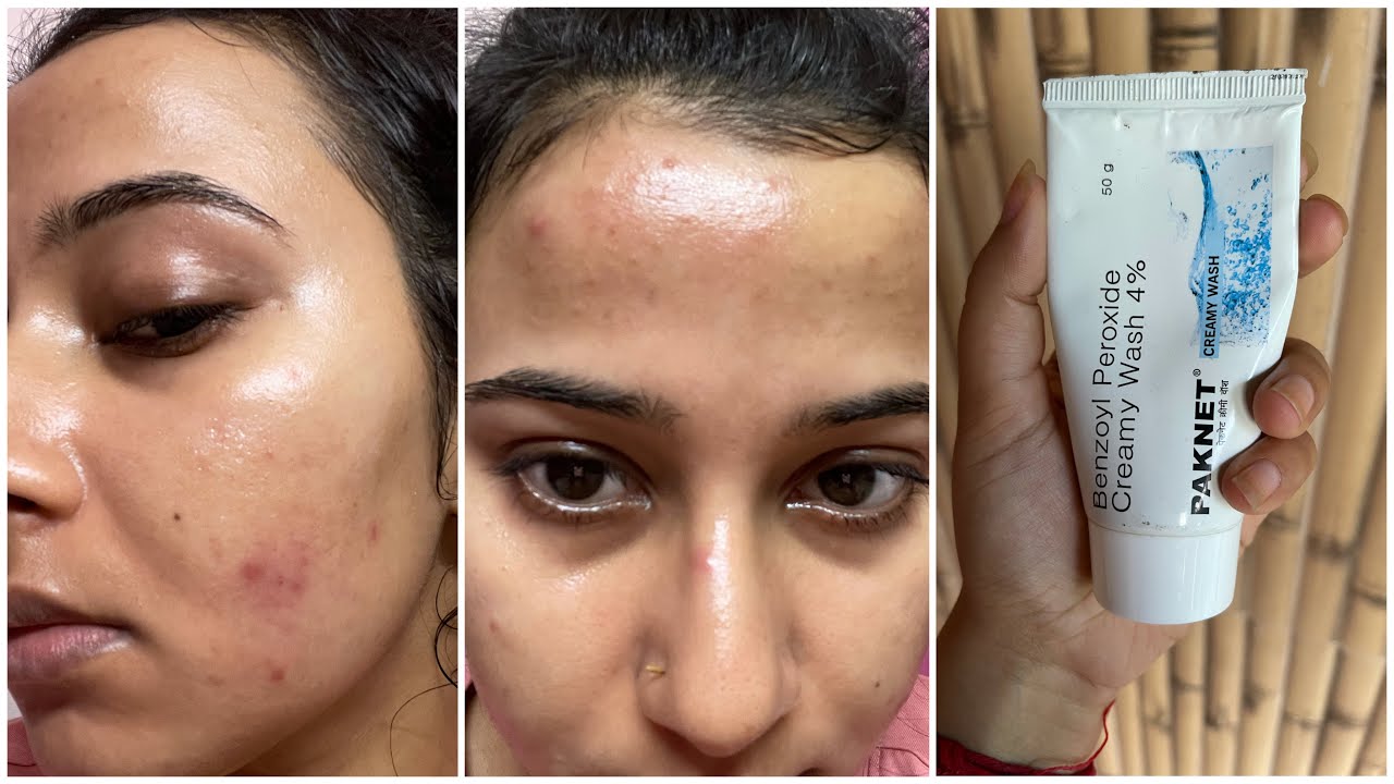 Dermatologist Recommended Face Wash that made my skin worse | PAKNET ...
