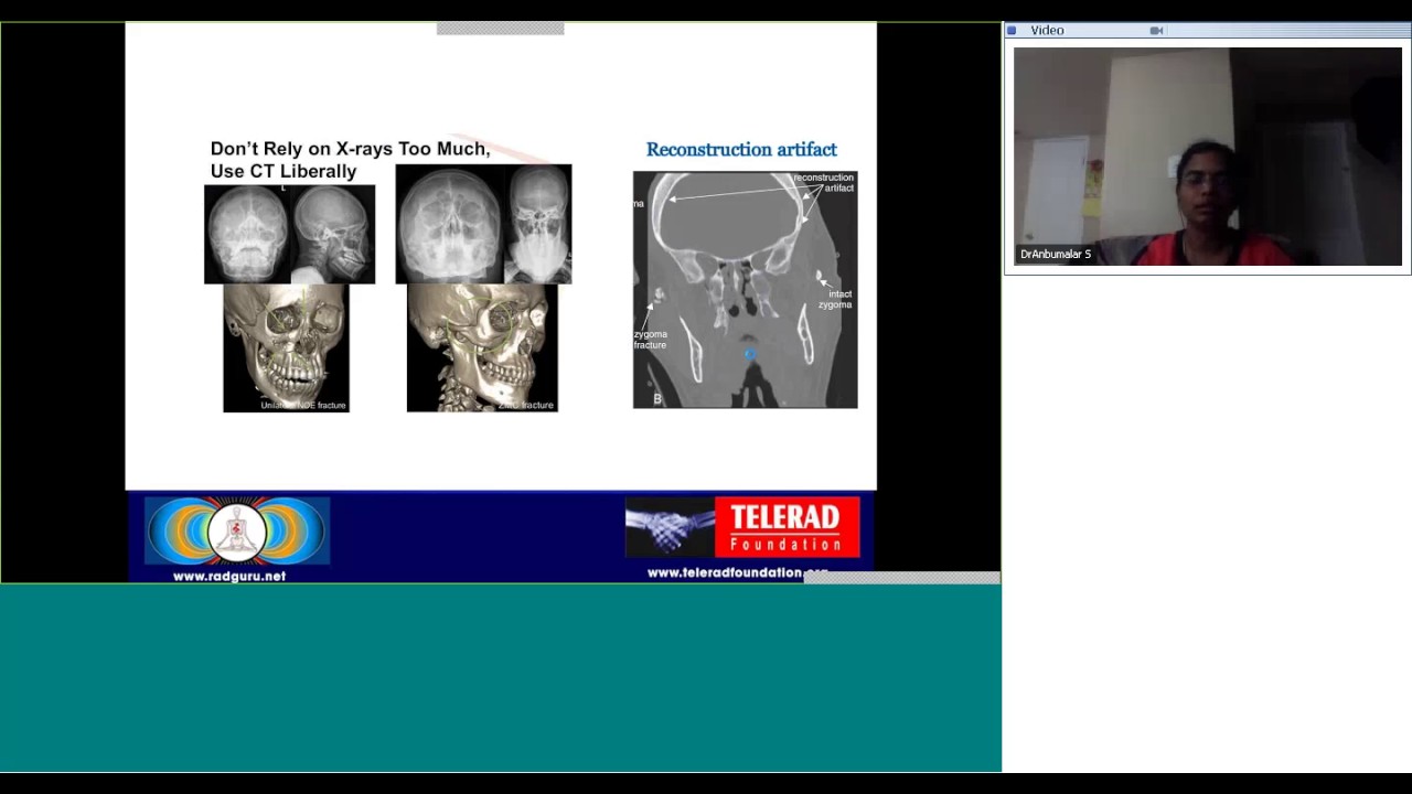 Maxillofacial Trauma Imaging by Dr Anbumalar - YouTube