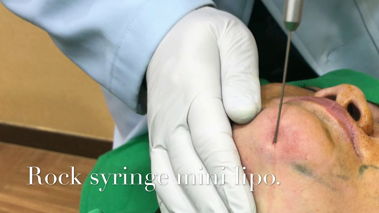 MINI LIPO. Jowl ACCUSCULPT procedure_2(IN SEOUL) あごの下歳除去 - YouTube