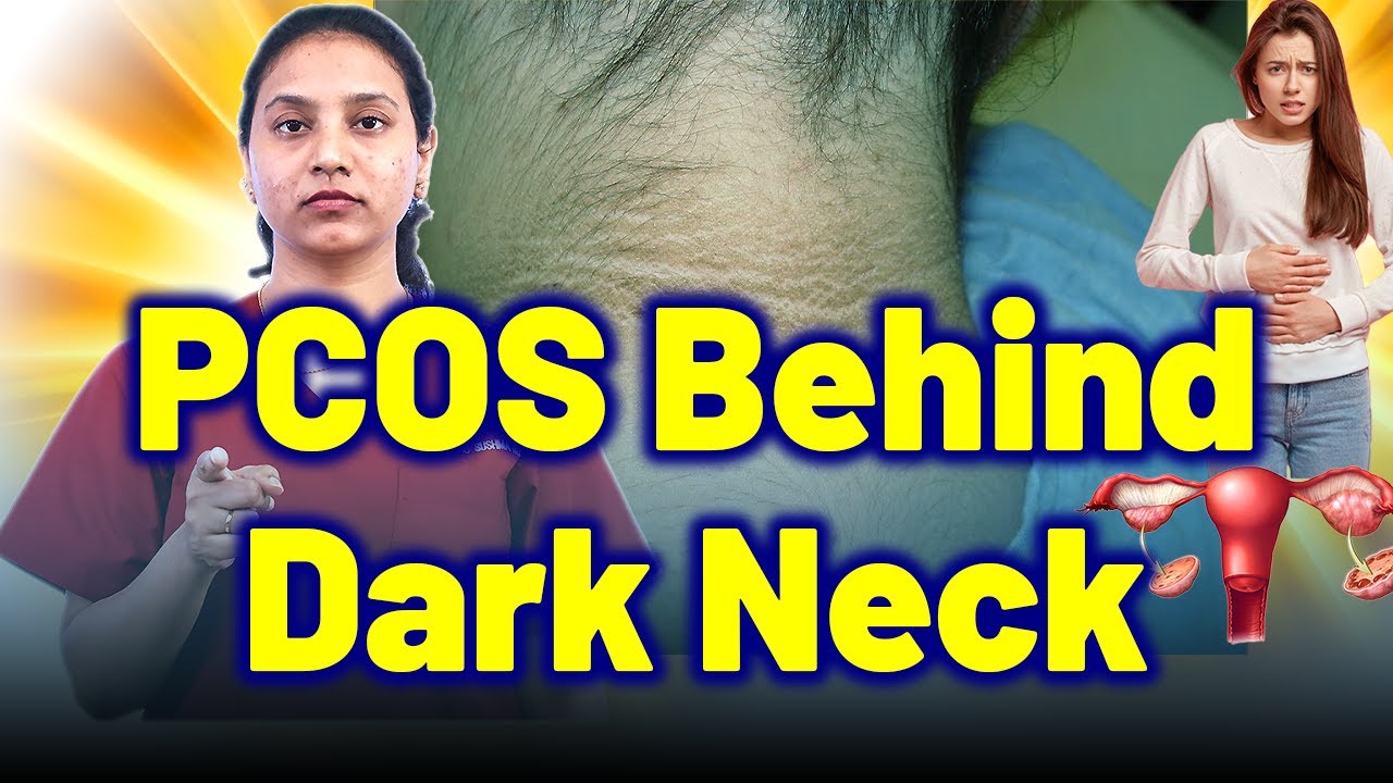 PCOS Causes Dark Neck, Dark Underarms, Skin Darkening, Acanthosis ...