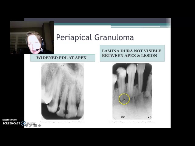 Periapical Radiolucency