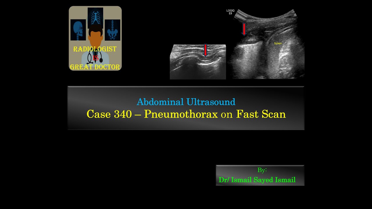 Ultrasound Case 340 - Pneumothorax on FAST Scan - YouTube