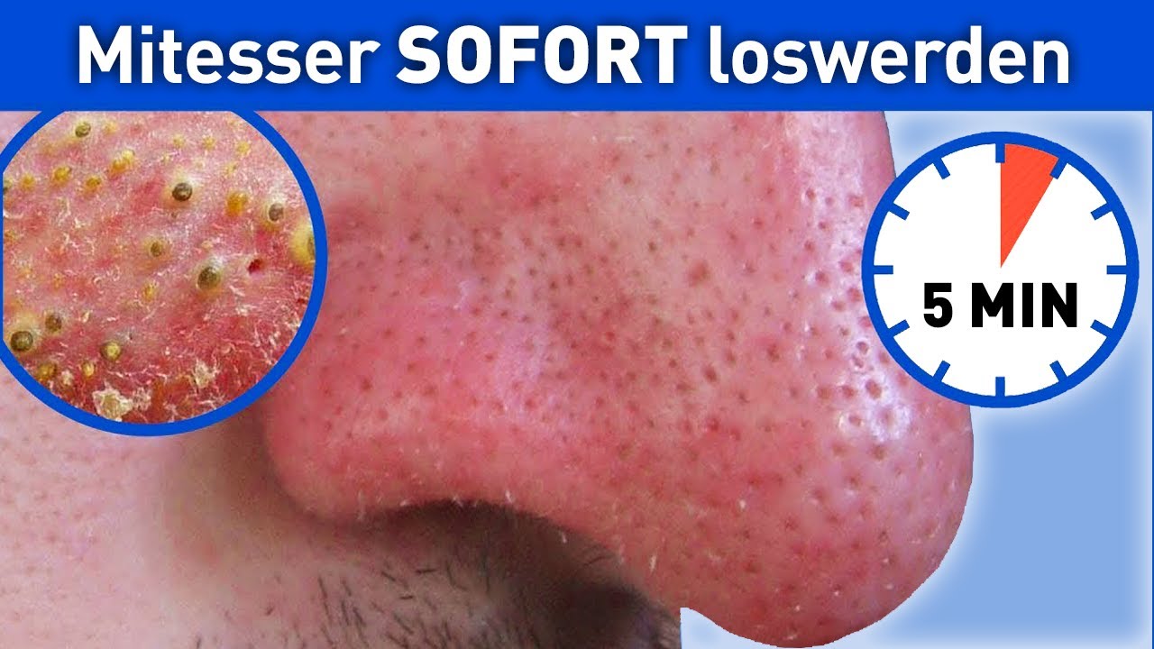 So wirst du Mitesser in weniger als 5 Minuten los! - YouTube