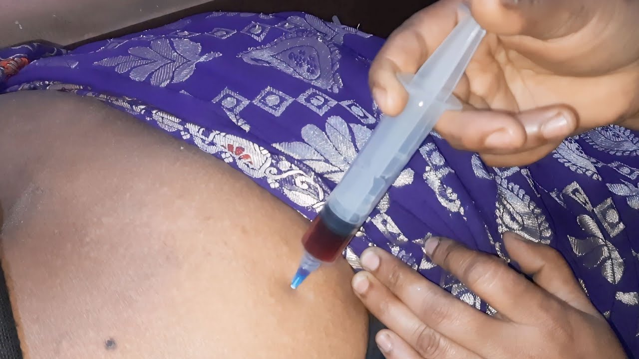 Buttock injection . Vitamin b1,b6,b12 "Becobion" Intramuscular buttock ...