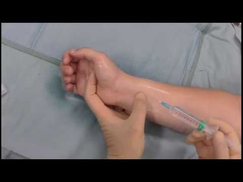 Landmark Technique for a Wrist Block - YouTube