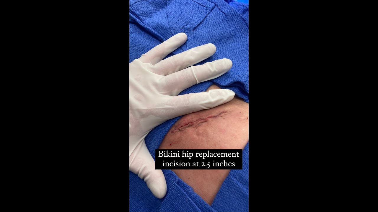 Direct Anterior Hip Replacement with Bikini Incision 1 Week Doing Great ...
